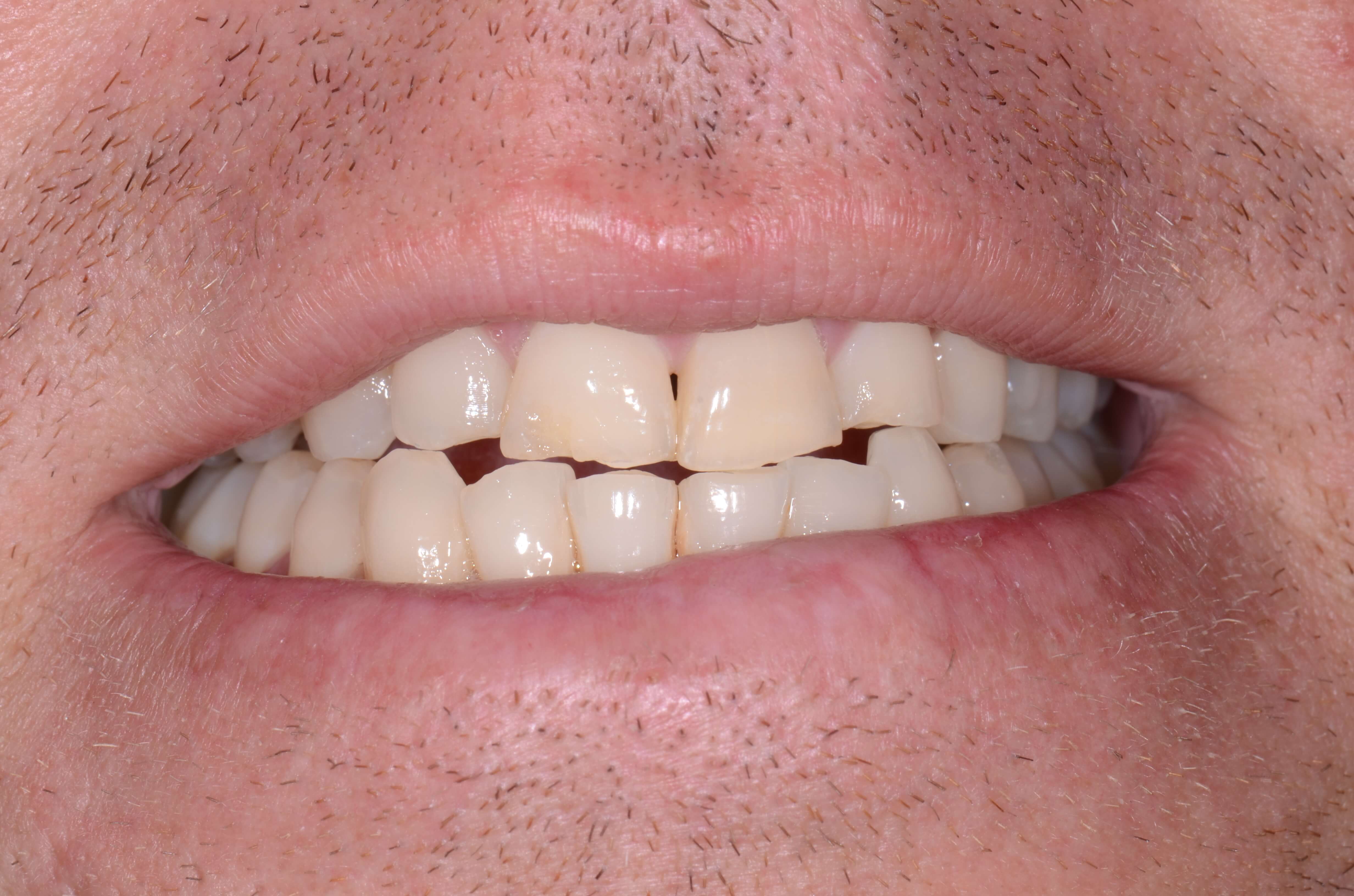 Patient Communication: You Grind Your Teeth - Restorative Nation