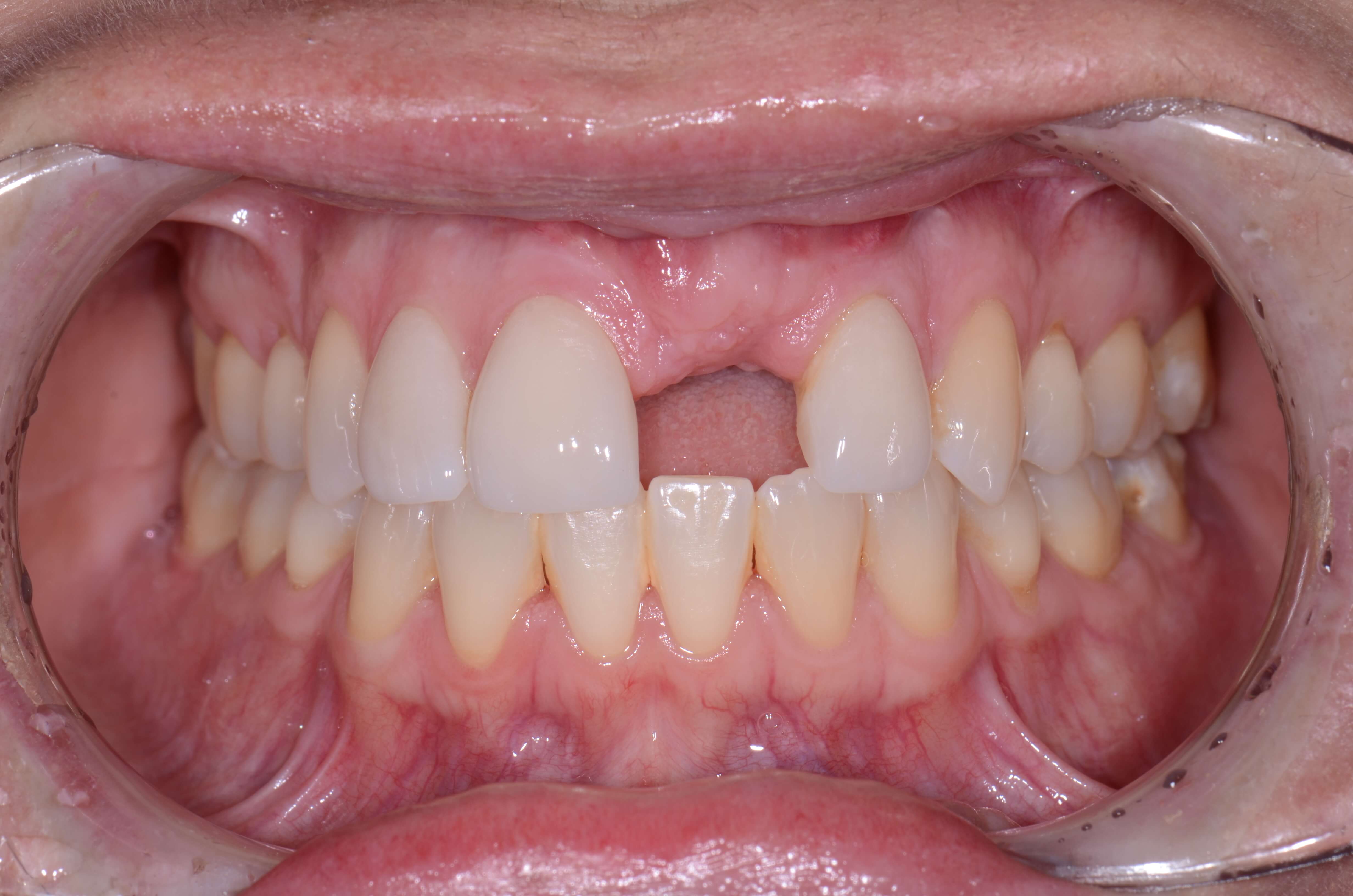 Anterior Implants and Triangular Teeth - Restorative Nation