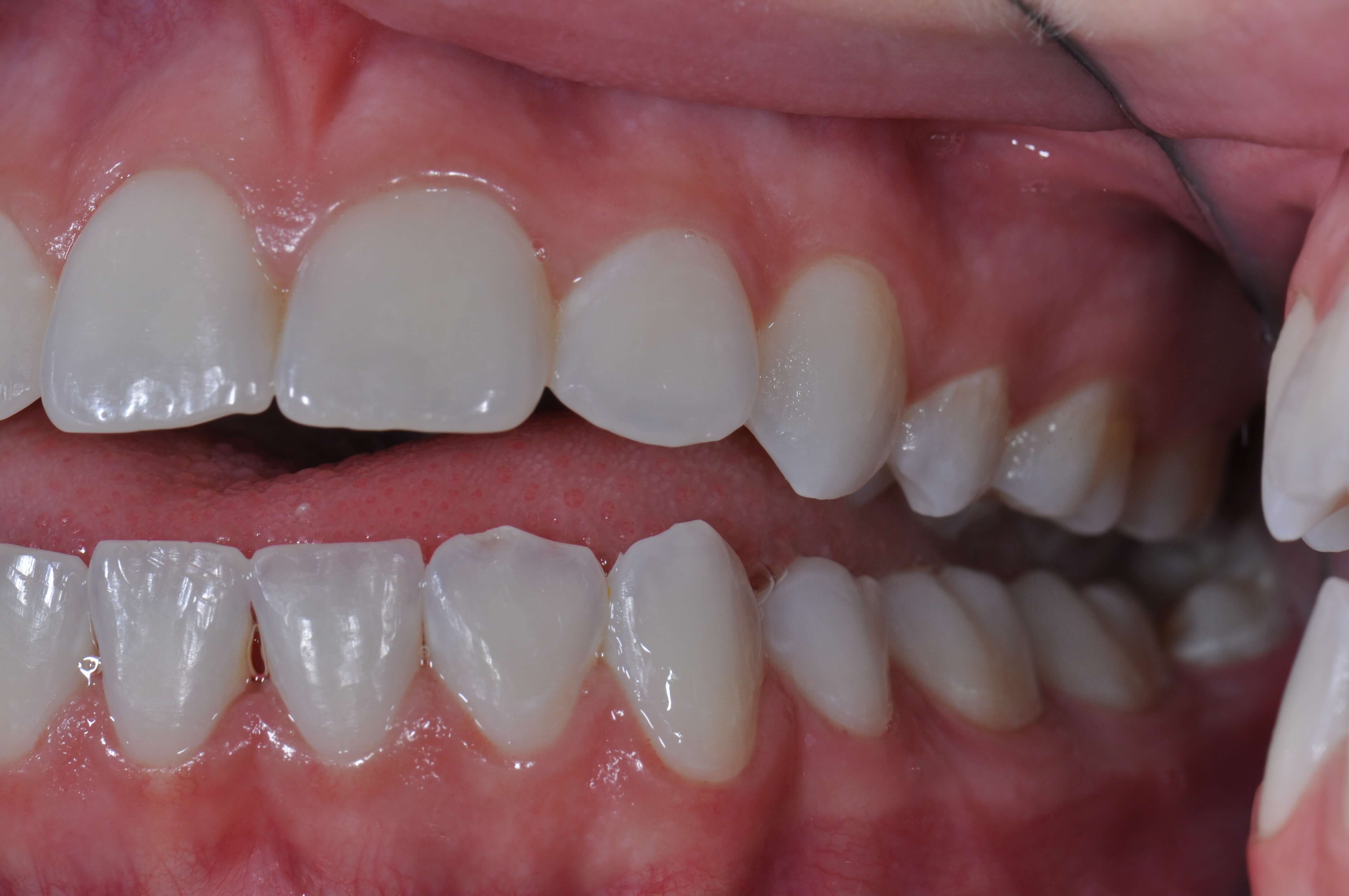 Anterior Implants: Incisor Inclination - Restorative Nation