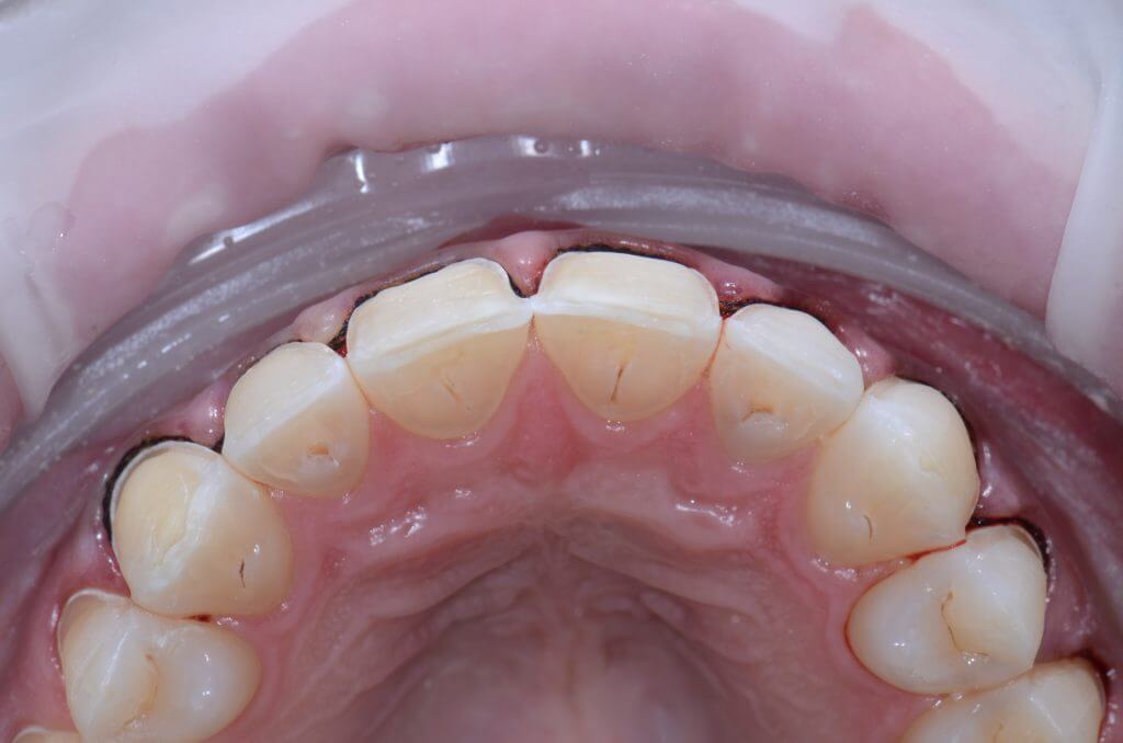 Anterior Veneers: Interproximal Prep Design - Restorative Nation