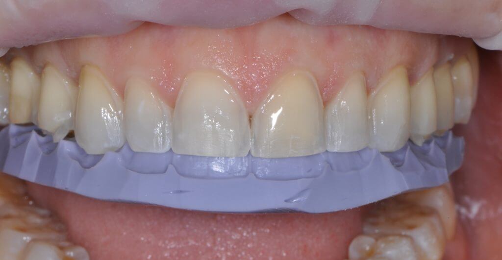 Porcelain Veneers: When To Cover The Incisal Edge - Restorative Nation