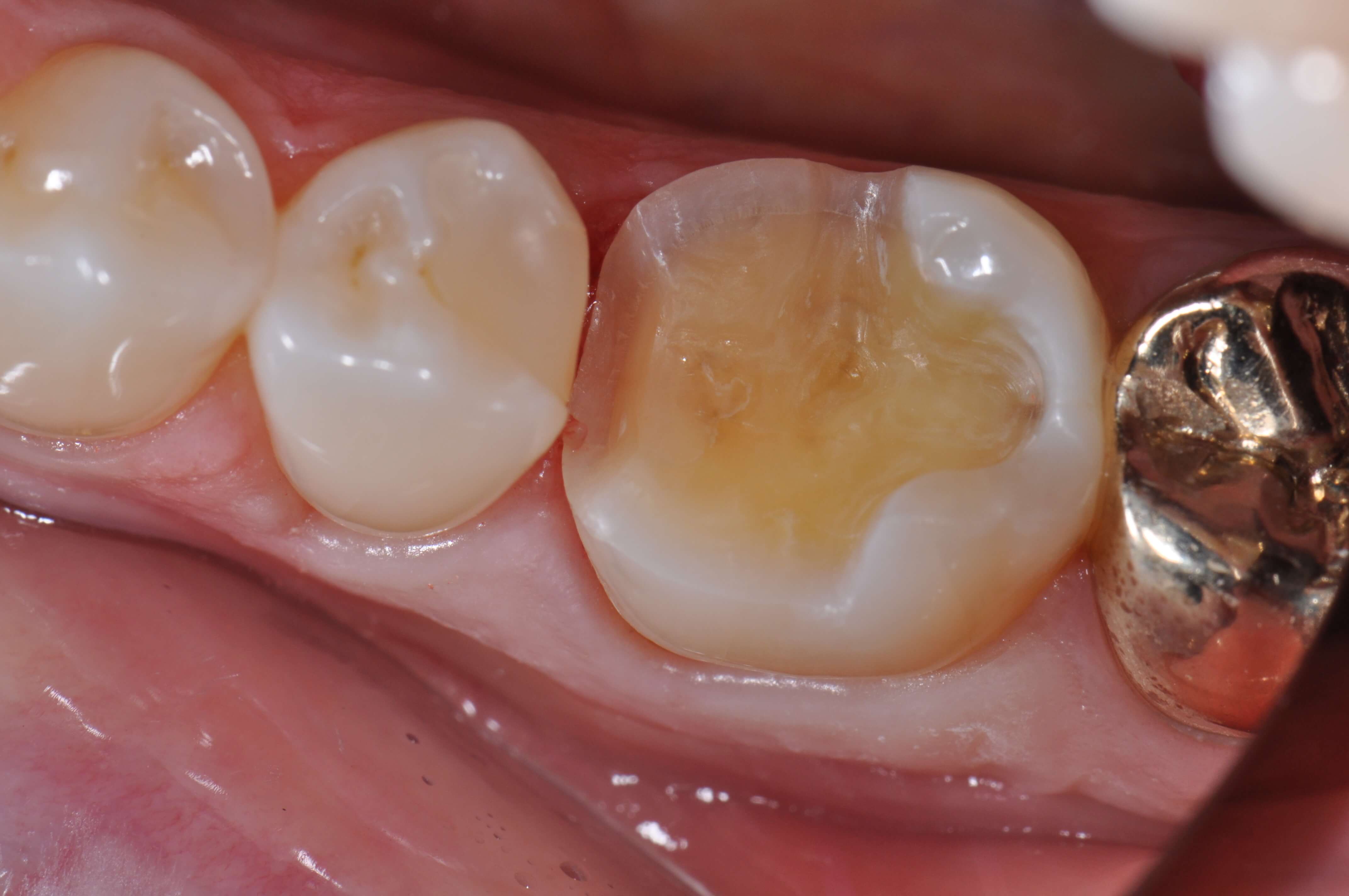 Posterior Partial Coverage Ceramic Preparation Design - Restorative Nation