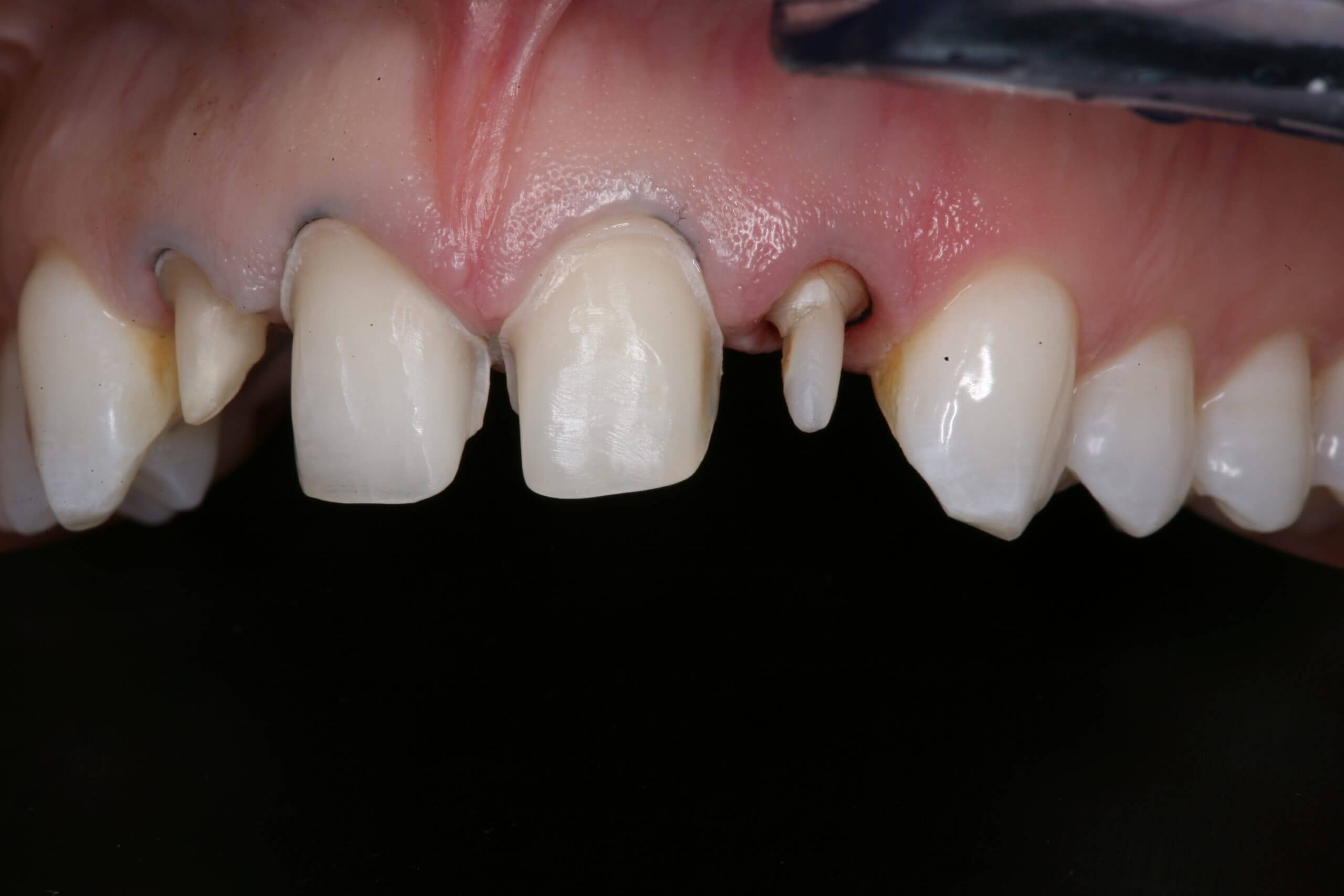 How Ferrule Impacts Restorative Decisions - Restorative Nation