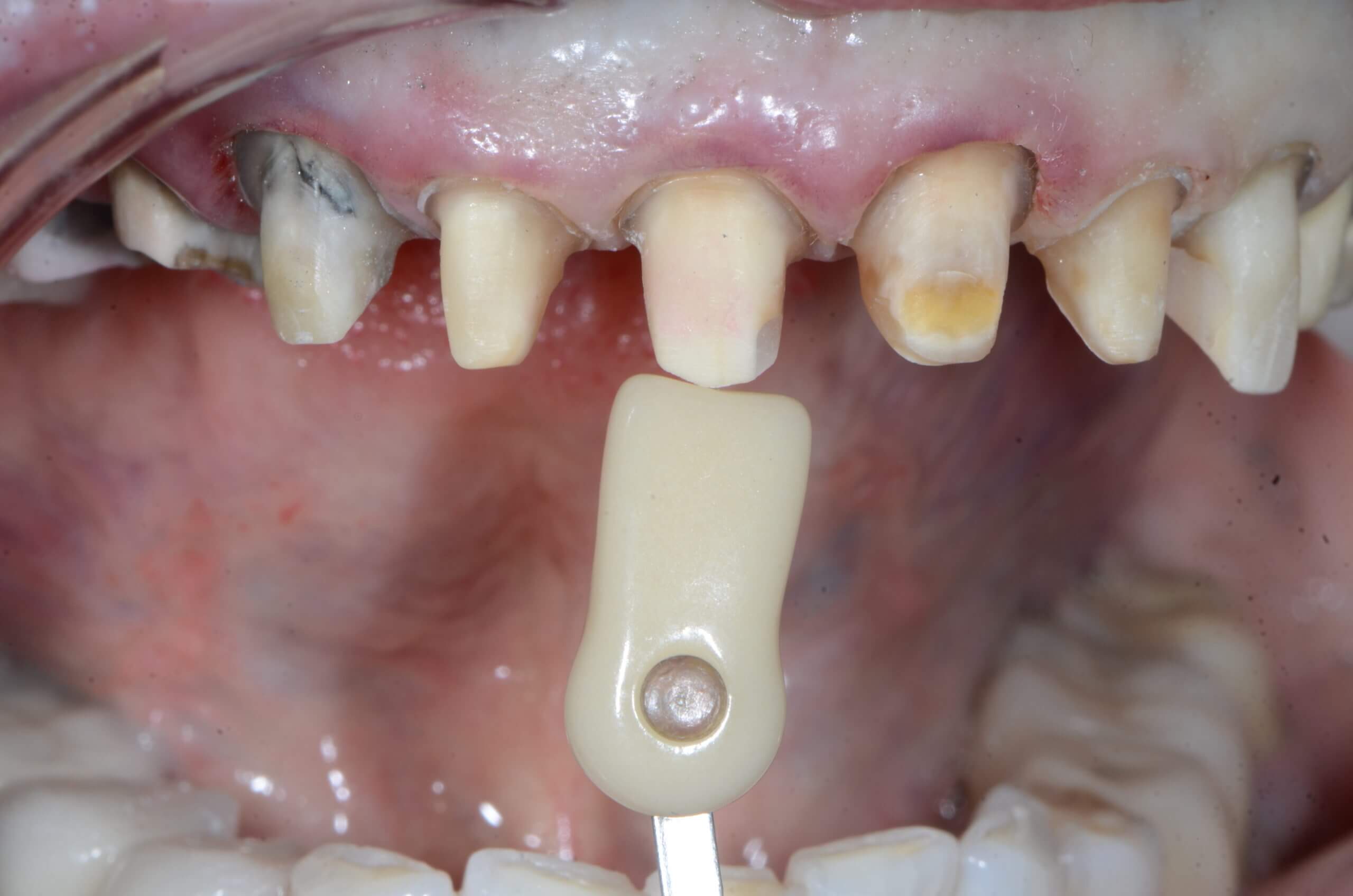 The Importance of a Dental Prep Shade - Restorative Nation