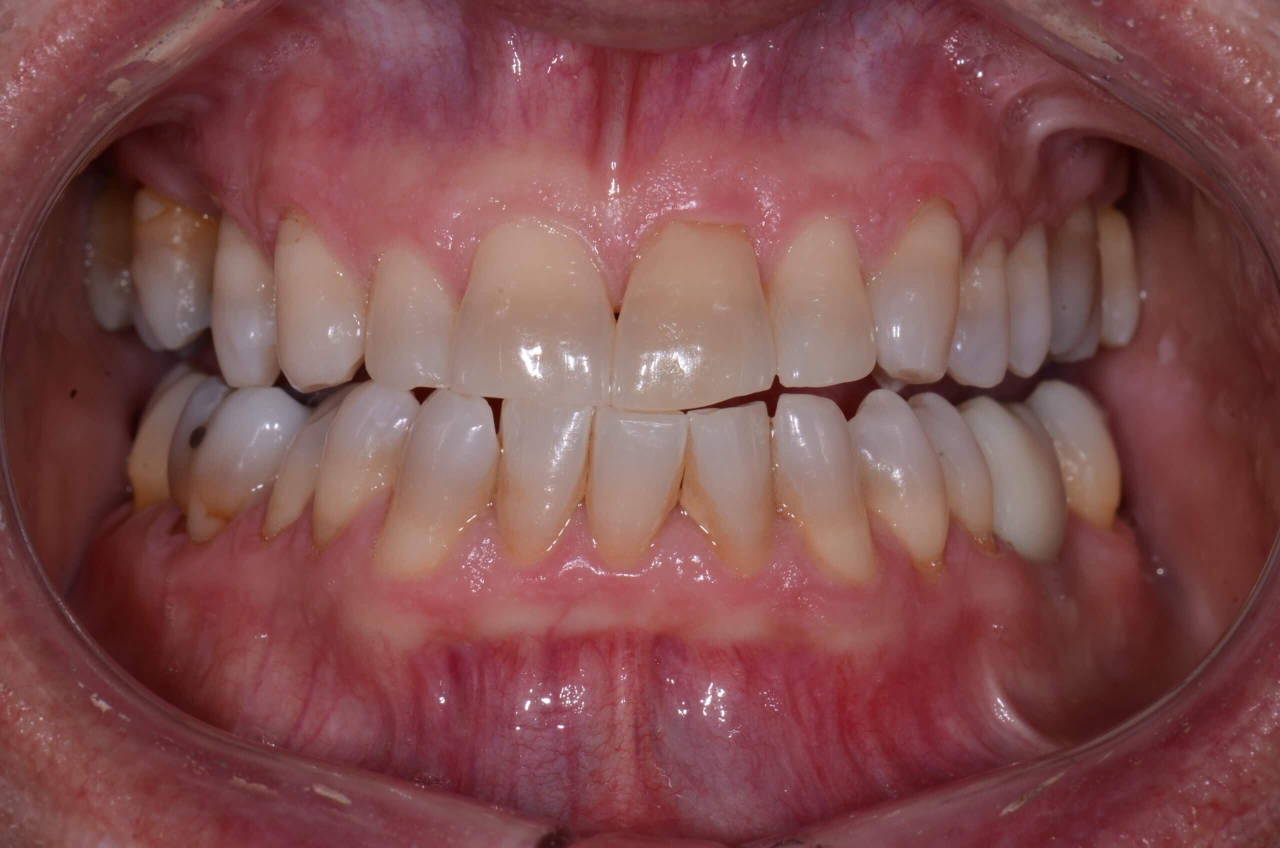Setting Condylar Inclination The Quick and Easy Way - Restorative Nation