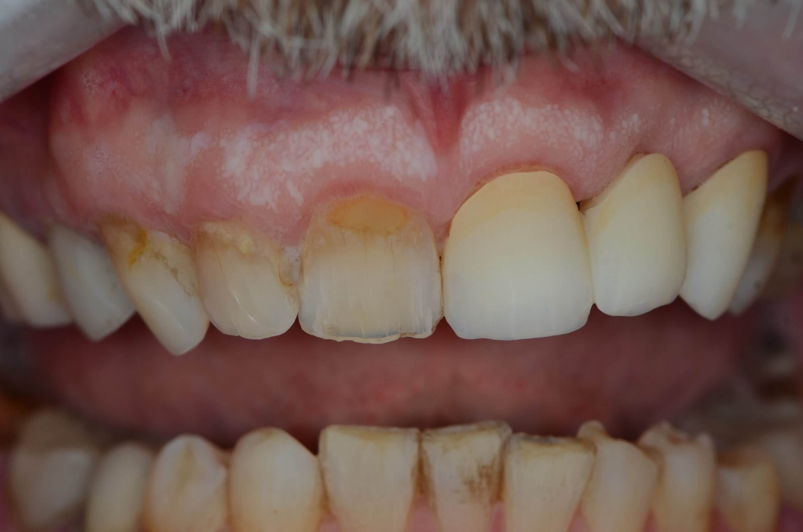 Improving Tooth Shade Communication with Cross Polarization ...