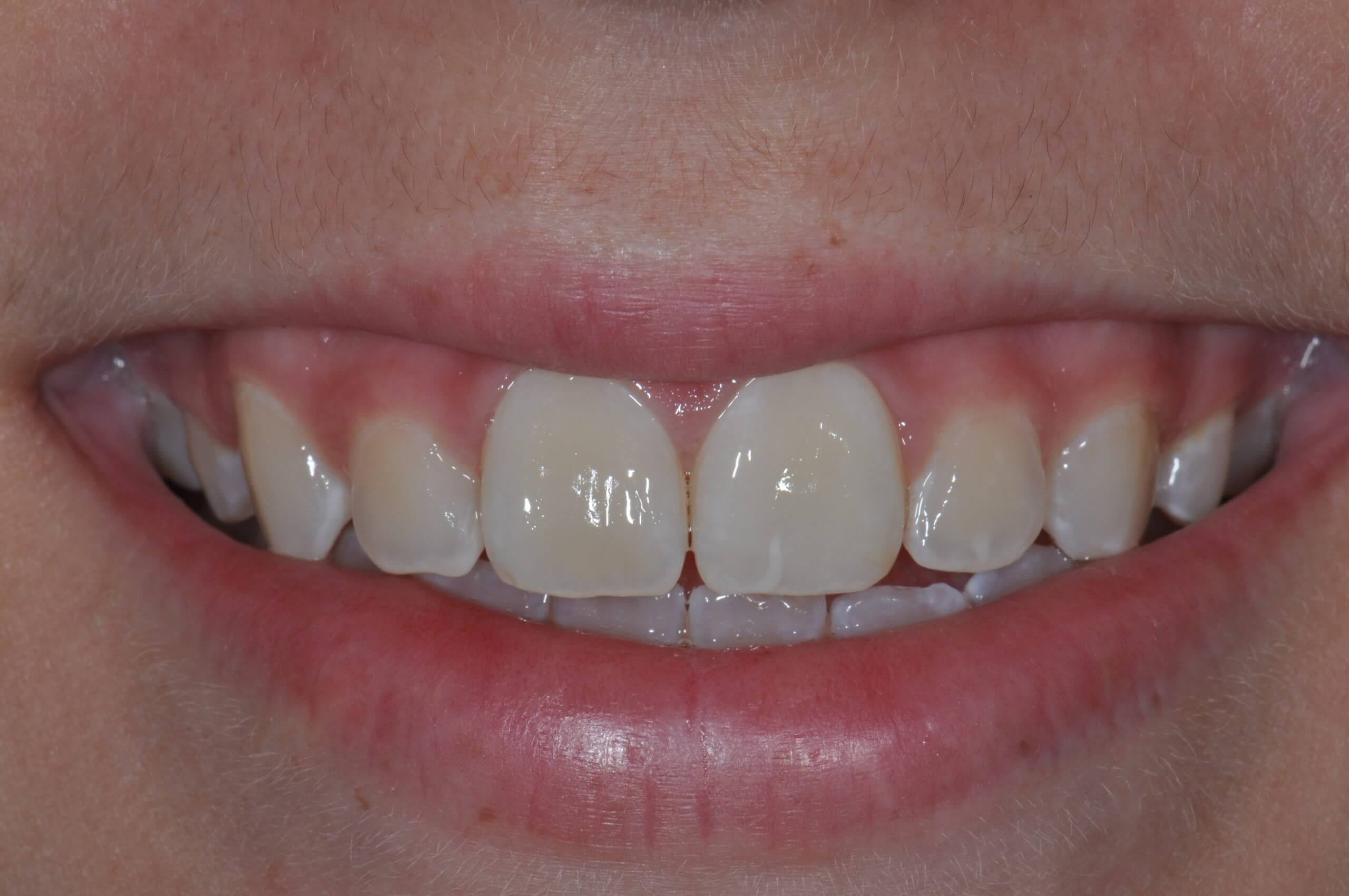 Diagnosing Altered Eruption Patterns - Restorative Nation