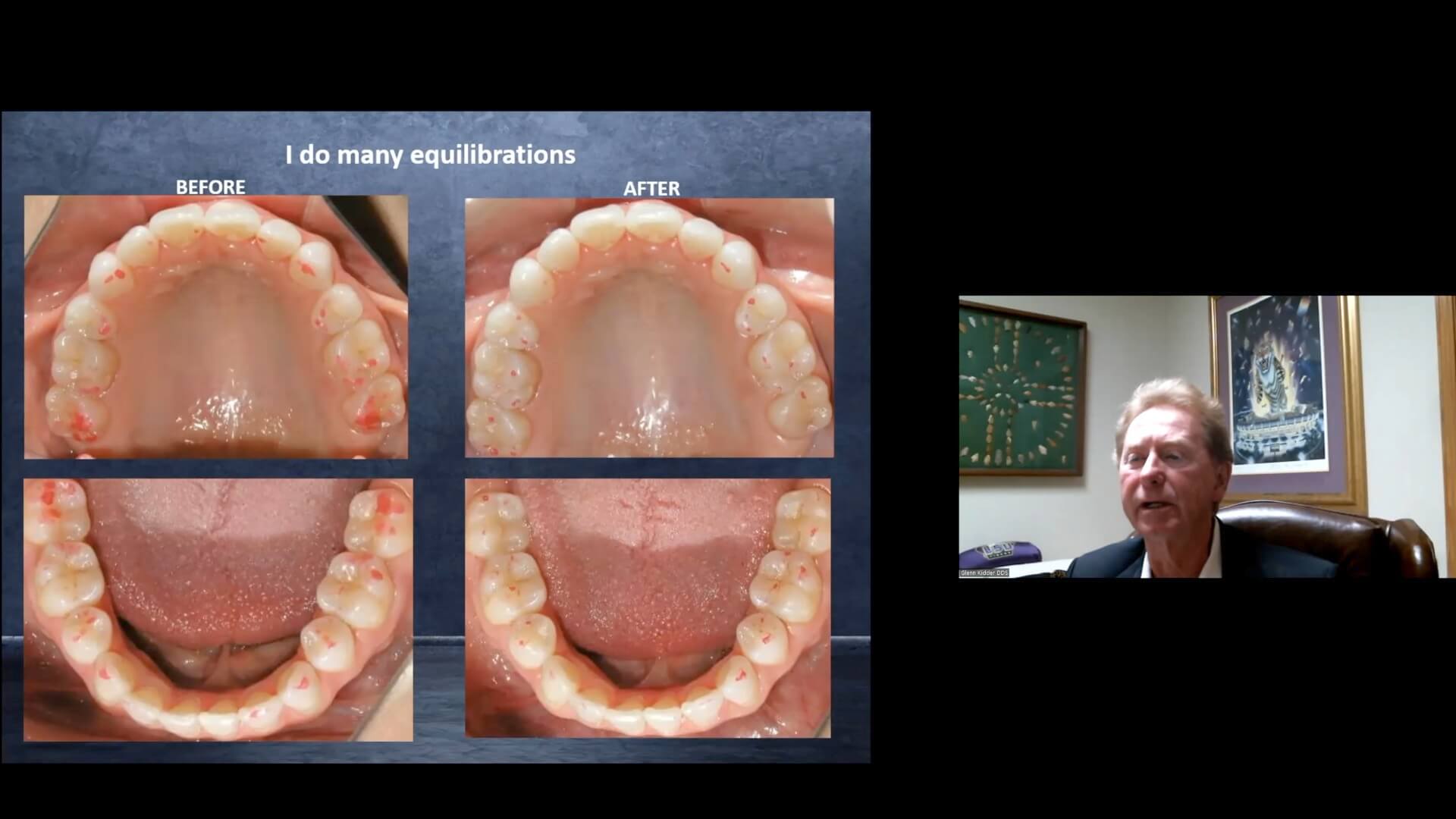 Mastering Esthetic Tooth Recontouring: The Importance of Incisal Edges ...