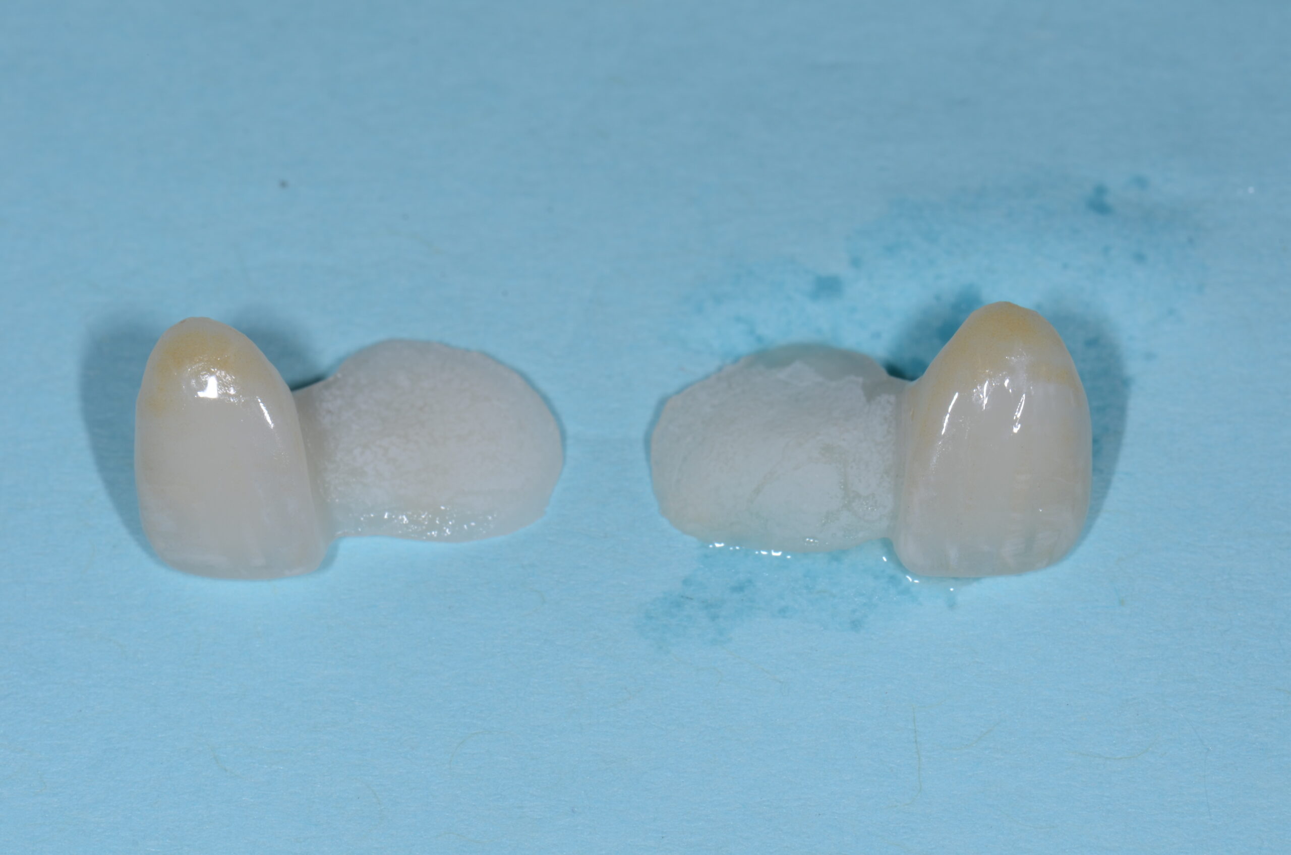 How Many Wings? A Crucial Detail for your Dental Restorations: Resin ...